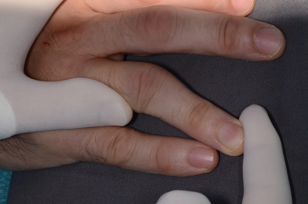 Sports Injuries of Finger Joints - CHARMS Singapore