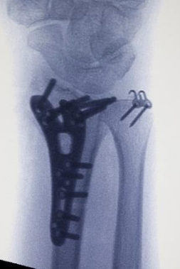 Distal Radius Fracture Treatment