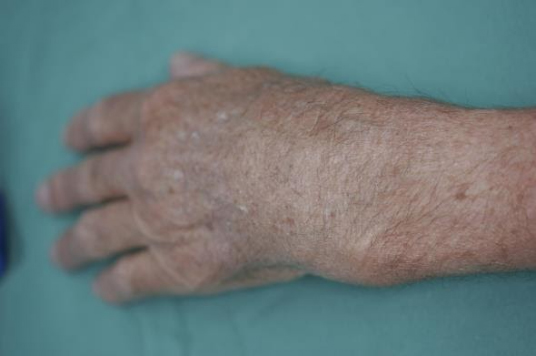 Distal Radius Fracture Treatment