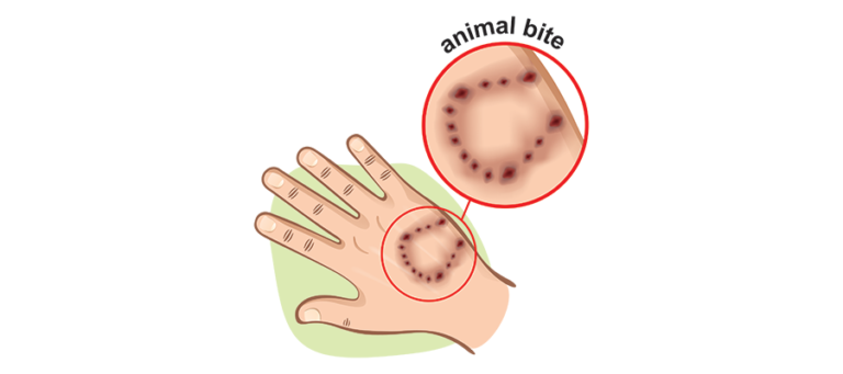 Hand Injuries From Animal Bites - CHARMS Singapore