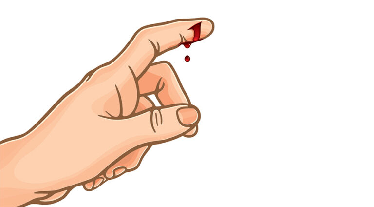 Have You Accidentally Stabbed Your Hand? Here’s What to Do. - CHARMS ...