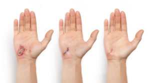 Have You Accidentally Stabbed Your Hand? Here’s What to Do. - CHARMS ...