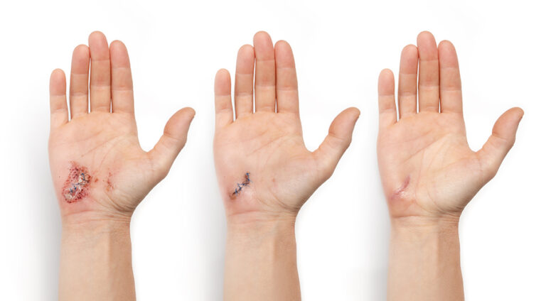 Have You Accidentally Stabbed Your Hand? Here’s What to Do. - CHARMS ...